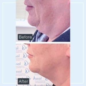 Celluform Plus - Fat loss Injection treatment | London Lip Clinic